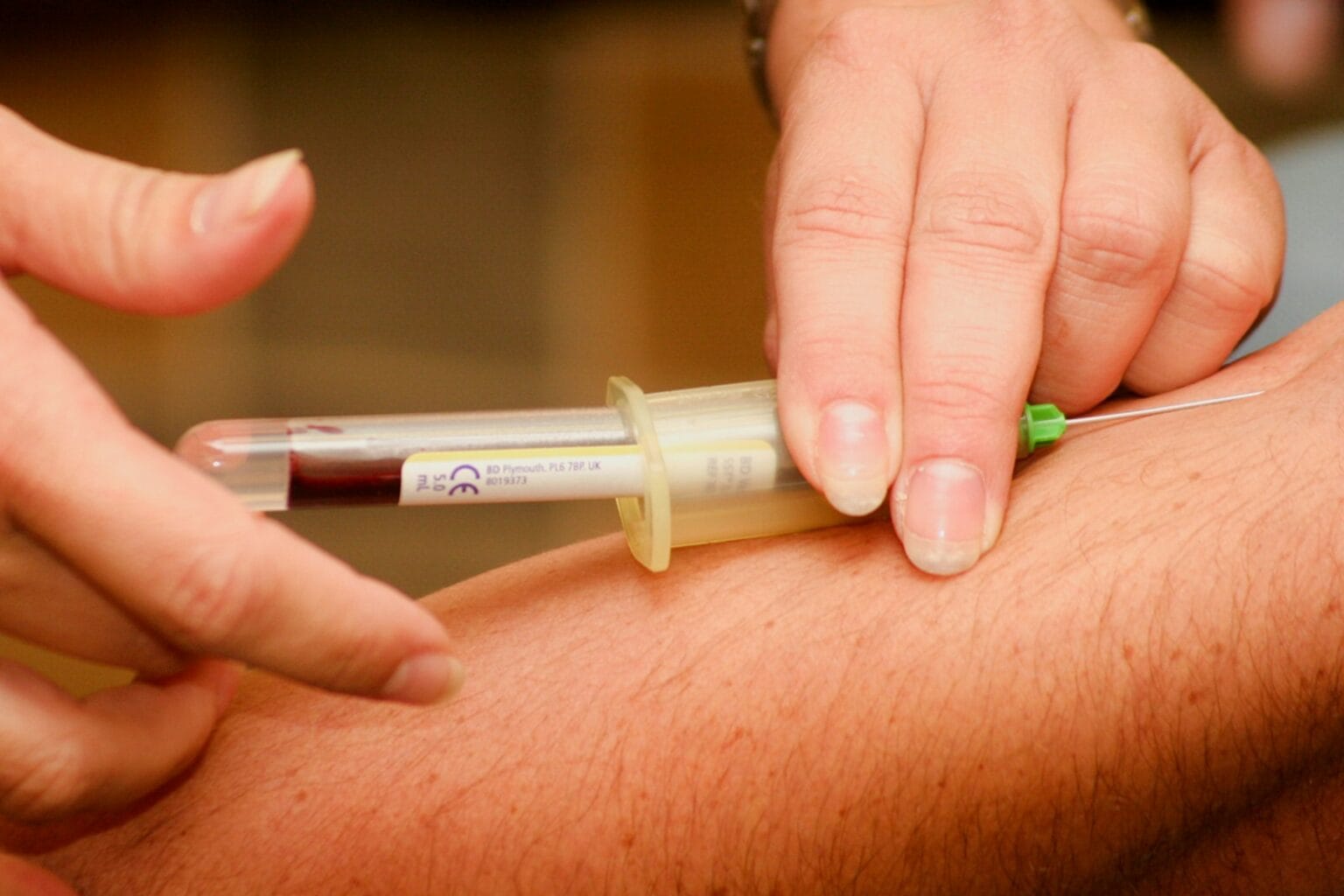 Anti-SSA Test (anti-Ro): Know Your Labs - The Lupus Encyclopedia
